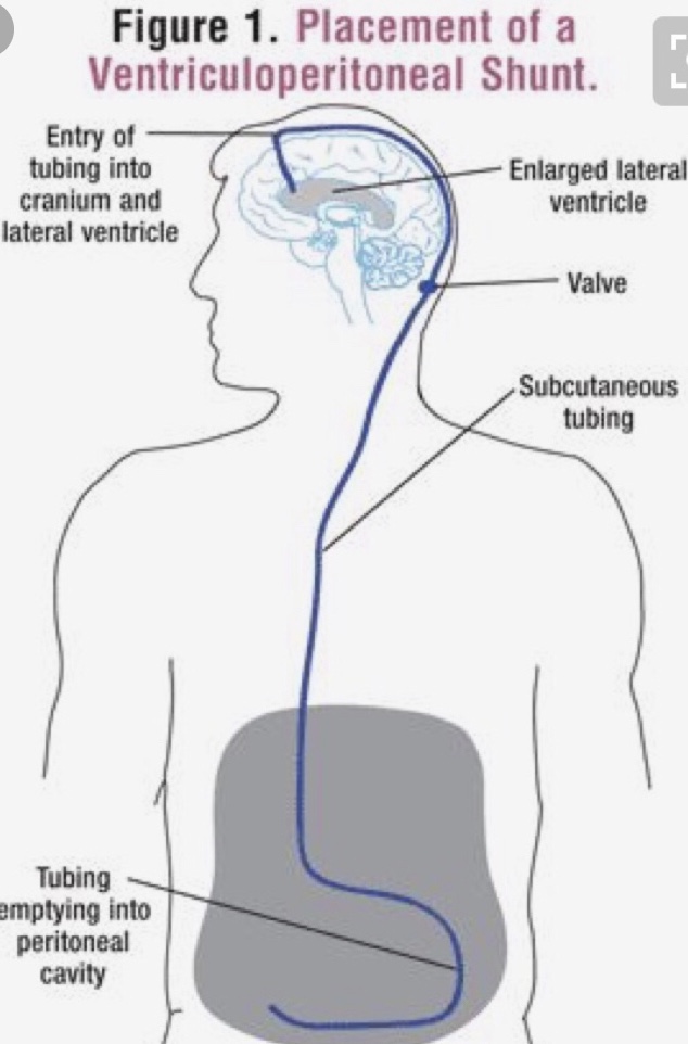 I mostly hate my shunt – Blissful Brain